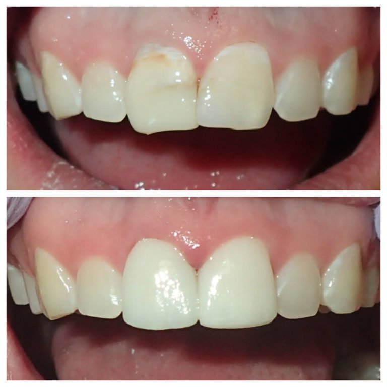 “Dr. Youssef, my front teeth are chipping and crowding up in the front ...